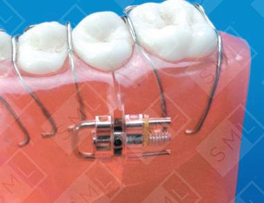 Upper Sagittal to Distalize Molars, Teeth Movement, Orthodontic Tools ...